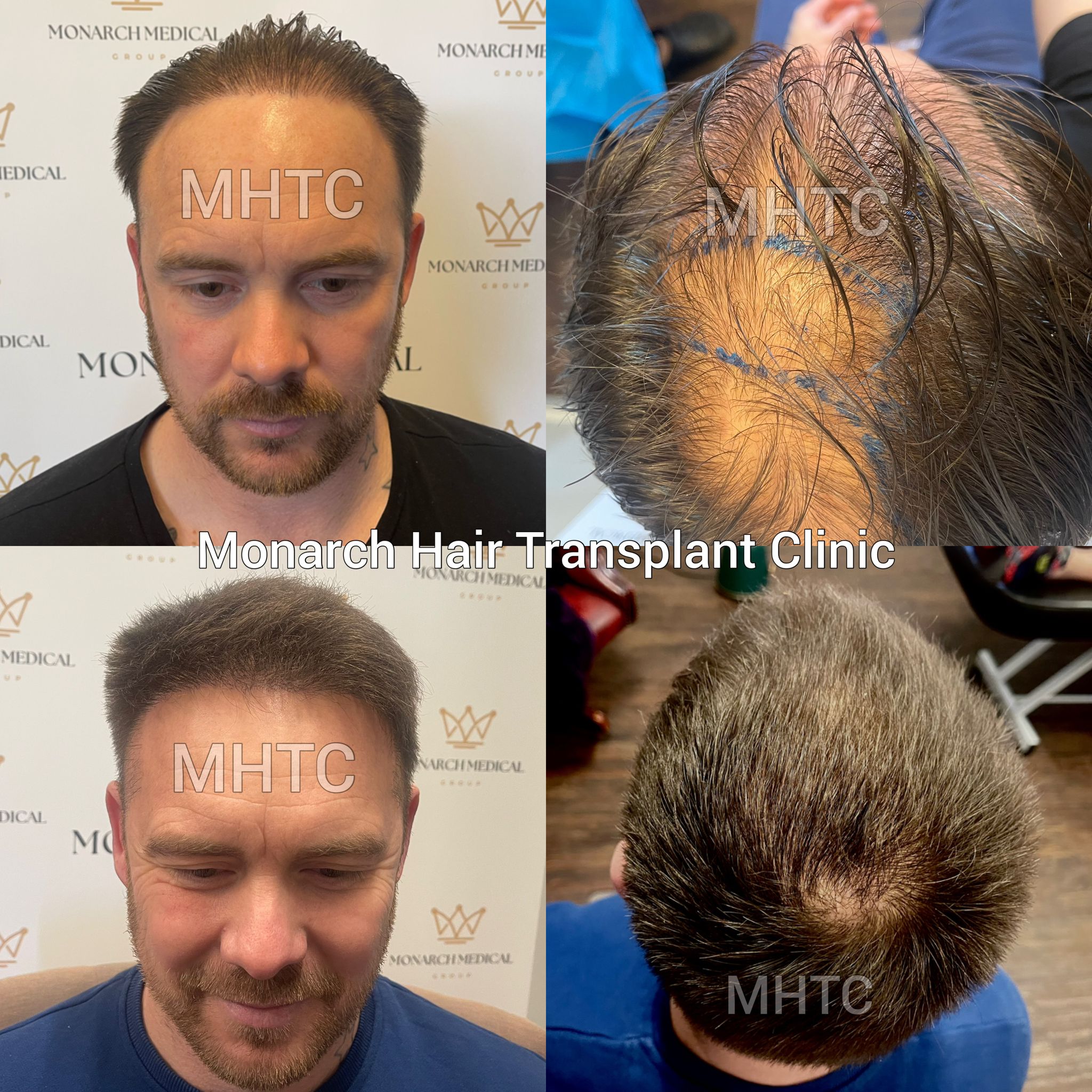 Gallery - Monarch Hair Transplant Clinic